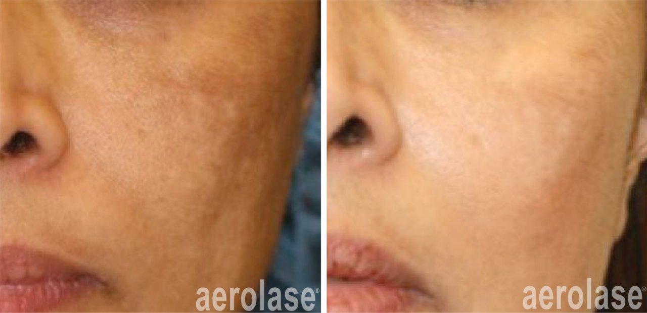 Neo Laser Treatment - Skin Deep Med Spa